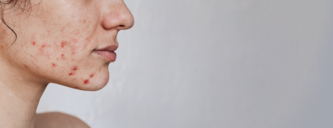 Understanding Acne: Types, Causes, and Effective Treatments for Clear Skin